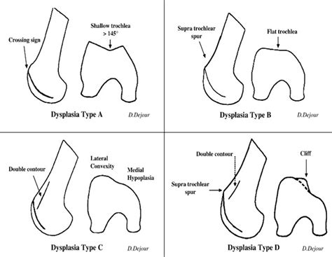 Tronchleoplasty Sparks Carson Nv Trochlear Dysplasia Reno Nv