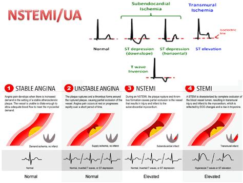 Non Stemi Vs Nstemi