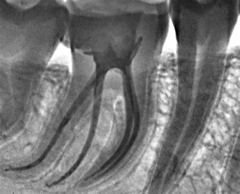 Radix Entomolaris A Case Series Style Italiano Endodontics