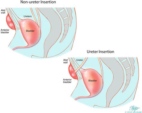 Epispadias Embryology Embryology Of The Urinary Tract Springerlink