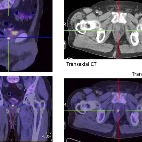 A 78 Year Old Patient With A Focal Fch Uptake In Prostatic Fossa After