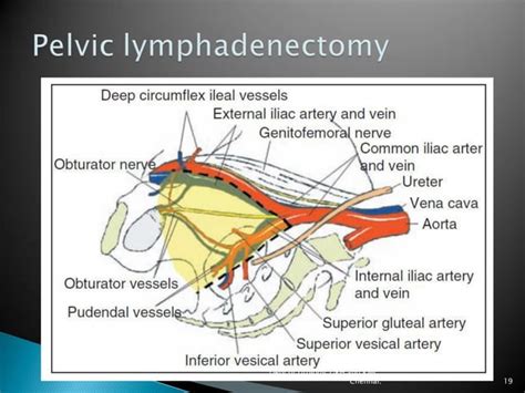 Prostate Carinoma Surgery Open Radical Retropubic Prostatectomyrrp