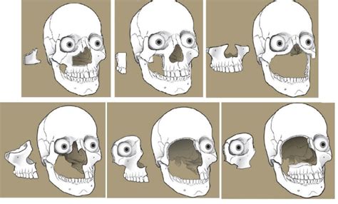 Classification Of Maxillectomy Defects 7a Type I Limited Maxillary Download Scientific