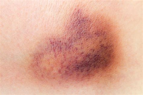 Can Breast Cancer Cause A Bruise Like Area On The Skin Scary Symptoms