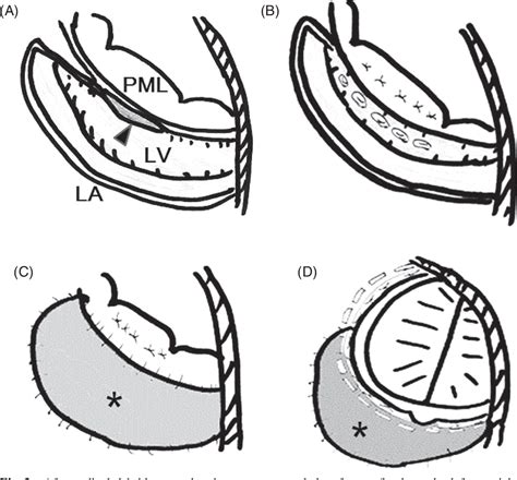 Figure 3 From Paravalvular Abscess Of The Mitral Valve With Fistula To