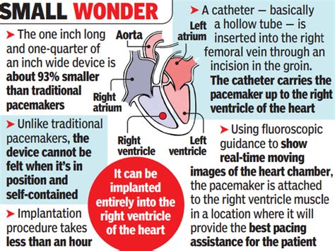 Pacemaker Smallest Pacemaker Implanted At Aiims Bhopal Bhopal News Times Of India