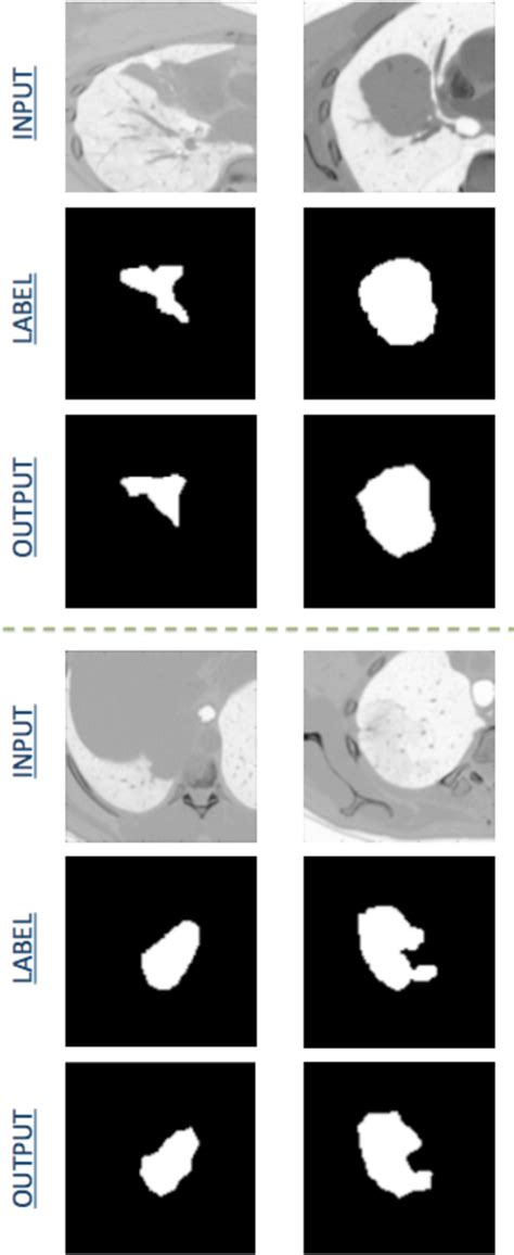 Figure 1 From Lung Tumor Segmentation Via Fully Convolutional Neural