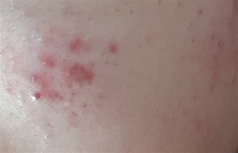 청소년 여드름 사진있음 지식in