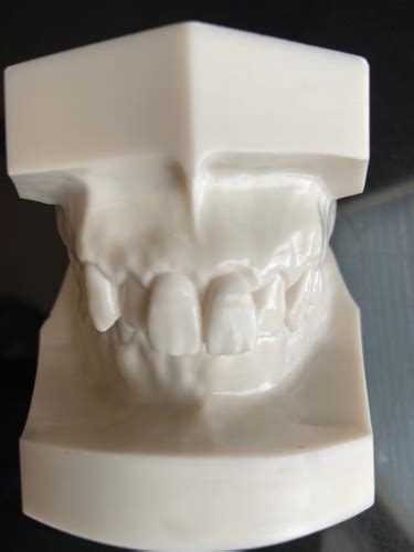 Angles Classification Malocclusion Parafunctional Habits Final Lab