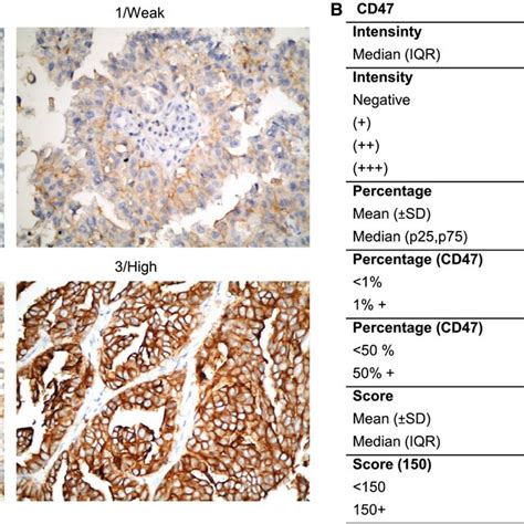 Cd47 Expression In Nsclc Patients A Representative Download Scientific Diagram