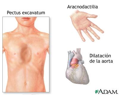 Síndrome De Marfan Medlineplus Enciclopedia Médica Illustración