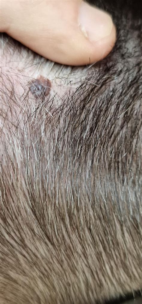 Lump On Scalp R Melanoma