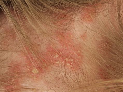 Pityriasis Capitis Roos Hoofdroos Seborroisch Eczeem Van De Hoofdhuid