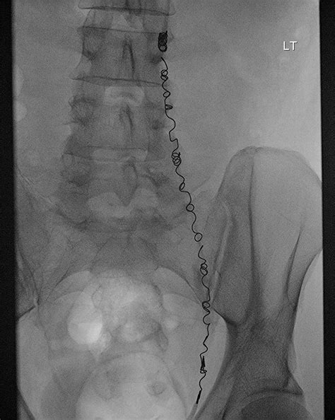 Coil Embolization Varicocele At Scott Lambert Blog
