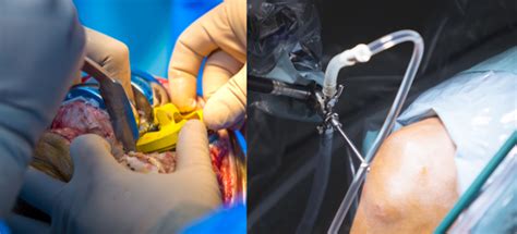 Arthroplasty Vs Arthroscopy Pros Cons And Recovery Explained Arthroplasty Vs Arthroscopy Pros Cons And Recovery Explained
