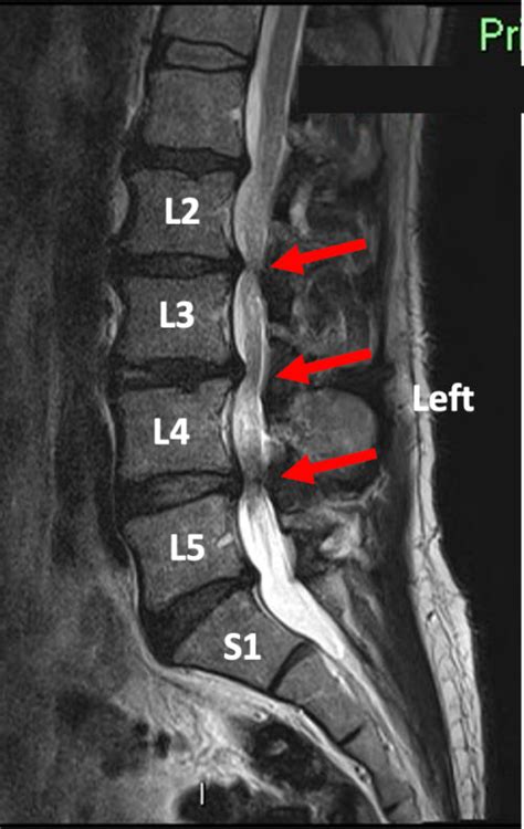 Laminectomy Dr Justin Smith