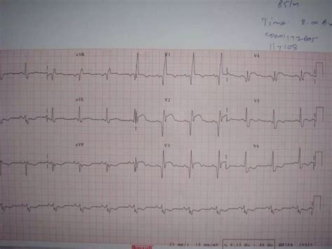 Ecg Bifascicular Block Pptx