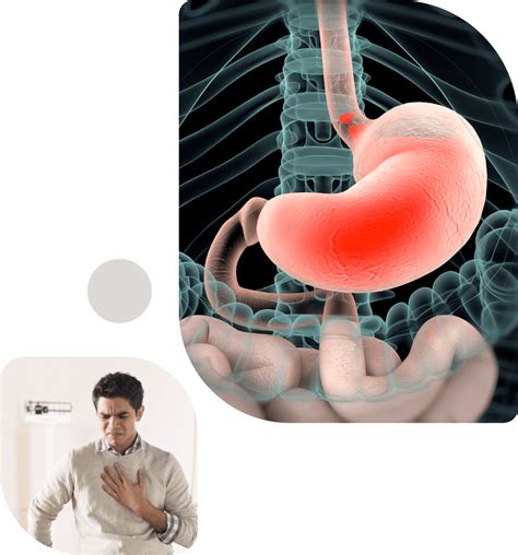 Gerd Tampa Bay Reflux Institute