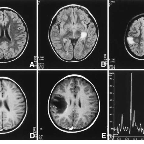 Axial Fluid Attenuated Inversion Recovery Magnetic Resonance Mr Download Scientific Diagram