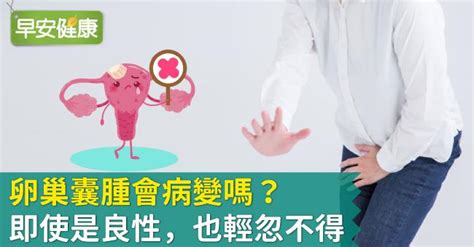 卵巢囊腫會消嗎？卵巢、子宮囊腫會不會癌病變？症狀、治療方法一次看