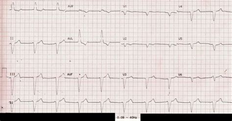 Ecg Filter Settings And Detection Of Pacemaker Spikes