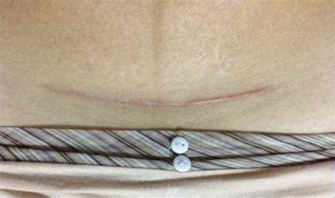 剖腹产横切和竖切从伤口上看有什么区别吗？ 孕小帮