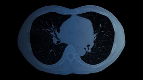 Chest Scan Your Partner In Lung Cancer Screening