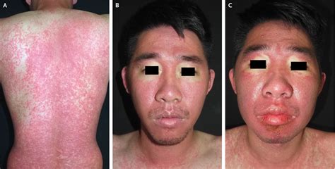 Drug Reaction With Eosinophilia And Systemic Symptoms Nejm