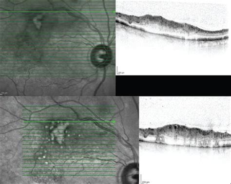 Pre And Post Cross Sectional Image On Spectral Domain Oct Spectralis Download Scientific