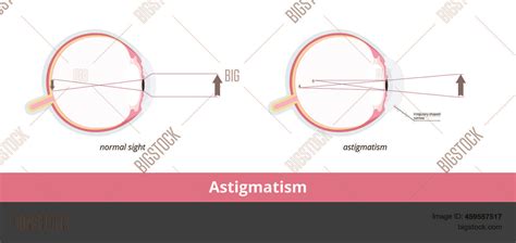 Astigmatism Common Vector And Photo Free Trial Bigstock