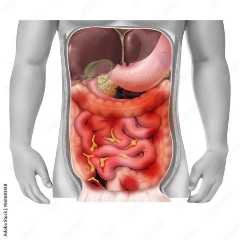 복막염 해부학 메디컬일러스트 Stock Illustration Adobe Stock