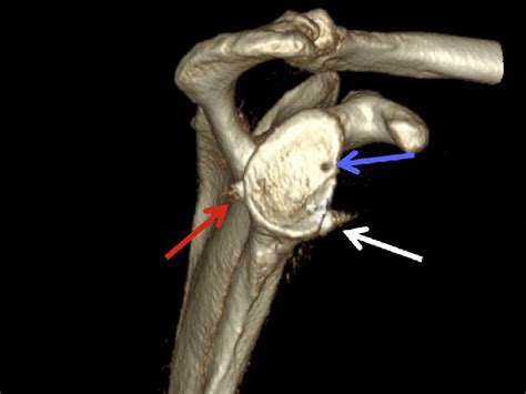 En Face View Of The Glenoid In The Right Shoulder On Computed