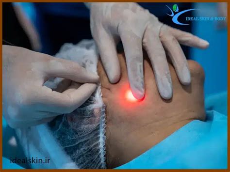 اندولیفت صورت روش نوین جوان‌سازی پوست