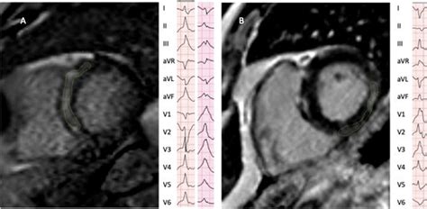 Two Predominant Scar Patterns Visualized With Lge On Cmr Scar Outlined