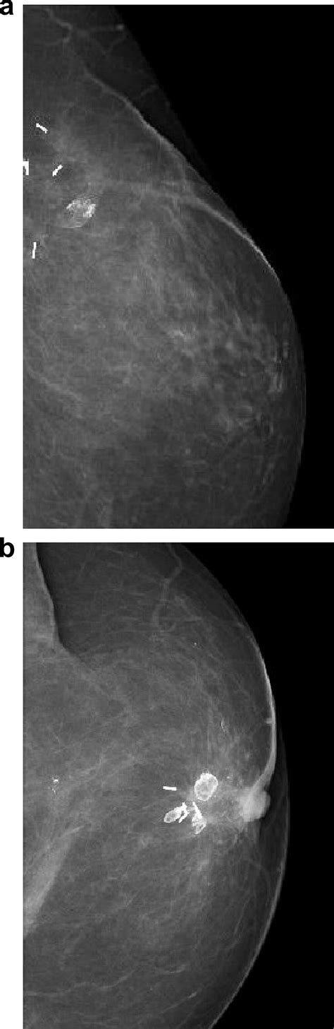 Fat Necrosis In Women With Early Stage Breast Cancer Treated With