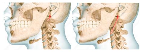 Styloid Process Neck The Sword In The Throat A Rare Case Of A 75 Cm