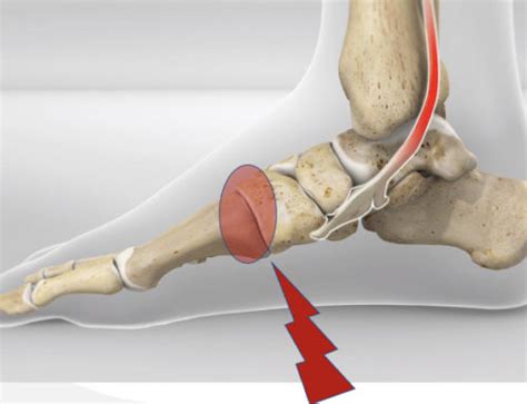 Extensor Tendonitis Foot Tendonitis Explained Dr Justin Dean