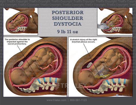 Posterior Shoulder Dystocia Trial Exhibits Inc