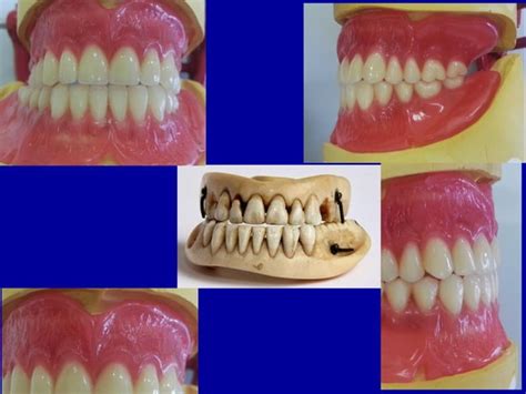 Plete Denture Wax‐up And Flasking Procedure Ppt