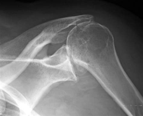 Posterior Shoulder Dislocation Orthopedics Medbullets Step 23