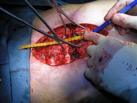 Sternum Plating System