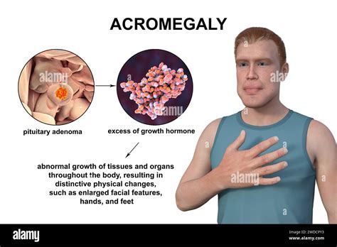 Illustration Depicting A Man With Acromegaly A Condition Which Results In The Enlargement Of Illustration Depicting A Man With Acromegaly A Condition Which Results In The Enlargement Of