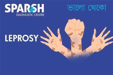Leprosy Sparsh Diagnostic Center