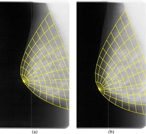Figure 1 From An Anatomically Oriented Breast Coordinate System For