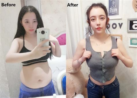 成都吸脂案例分享丨水动力腰腹环吸 水桶腰轻松变成水蛇腰 知乎