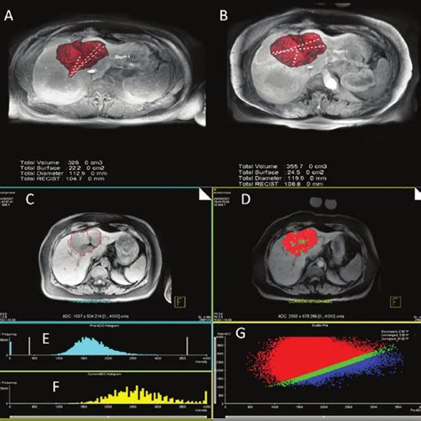 Images In 68 Year Old Woman With Cholangiocarcinoma Treated By Using Download Scientific Images In 68 Year Old Woman With Cholangiocarcinoma Treated By Using Download Scientific