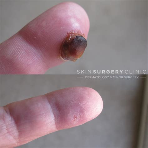This Pyogenic Granuloma Was Removed Skin Surgery Clinic
