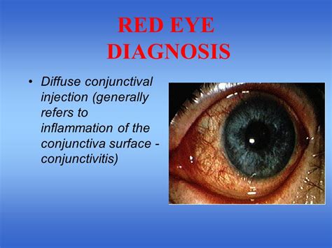 Red Eye Syndrom Ppt Video Online Download
