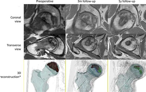 Volume And Location Of Bone Regeneration After Autologous Expanded Mesenchymal Stromal Cells In