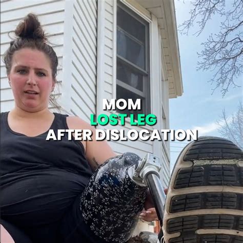 Mom Lost Leg After Dislocation Human Leg She Was Playing With Her